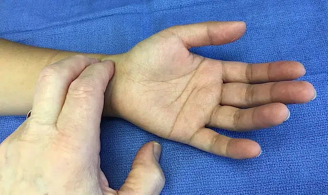 Radial Pulse